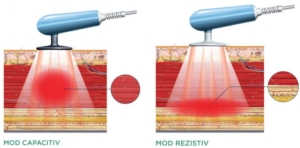 Terapia TECAR - ce este, beneficii, efecte, indicații, contraindicații